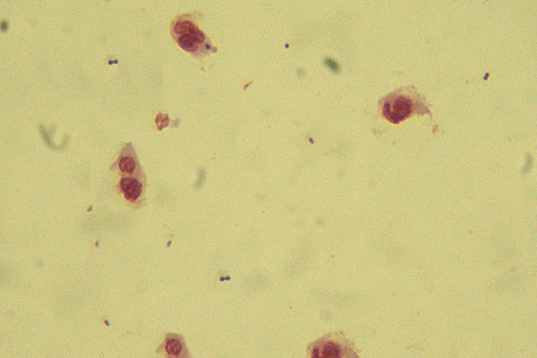 Medical Laboratory and Biomedical Science: CSF Gram Stain Case