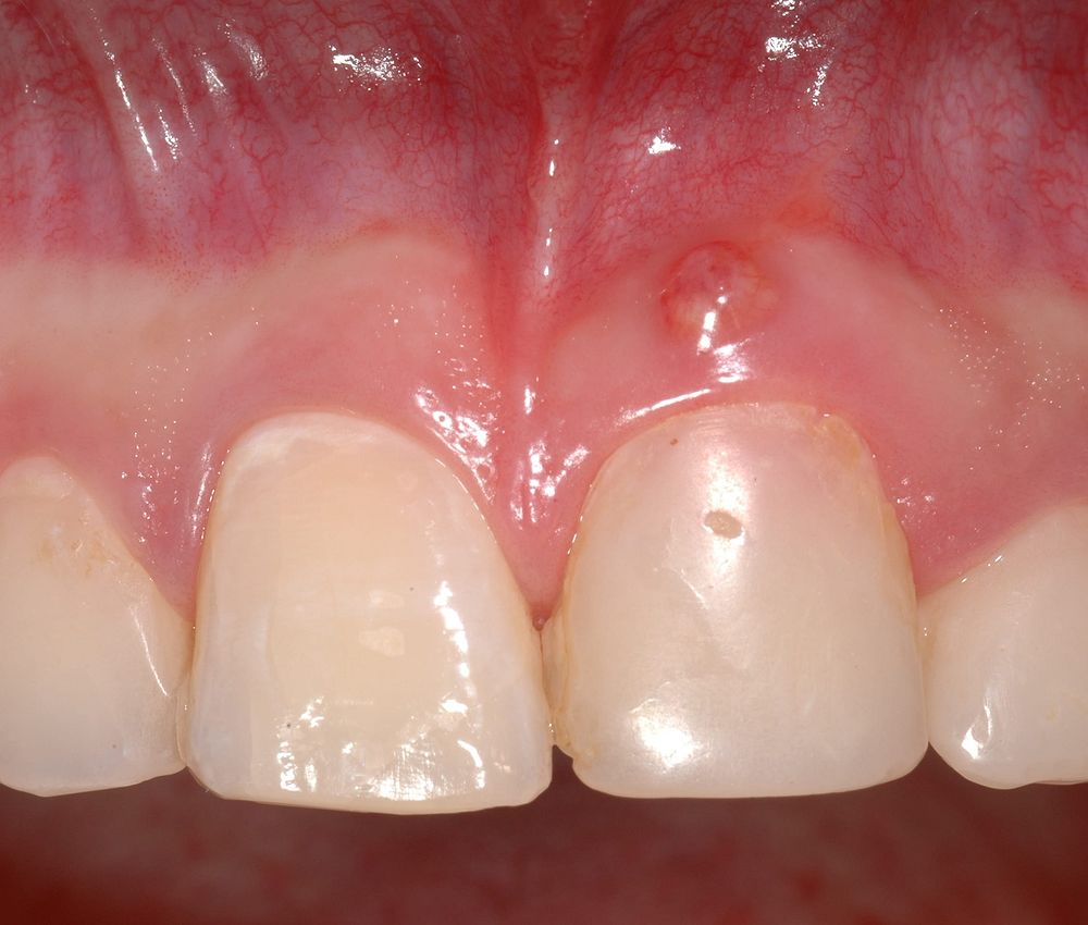 ORAL SURGERY How To Treat A Dental Fistula Directorio Odontol gico oral-surgery-how-to-treat-a-dental-fistula-directorio-odontol-gico