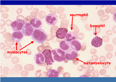Dentistry and Medicine: CHRONIC MYELOID LEUKAEMIA