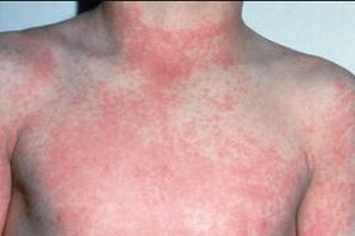 Scarlatina Rash Pictures | Medical Pictures and Images - (2023 Updated)