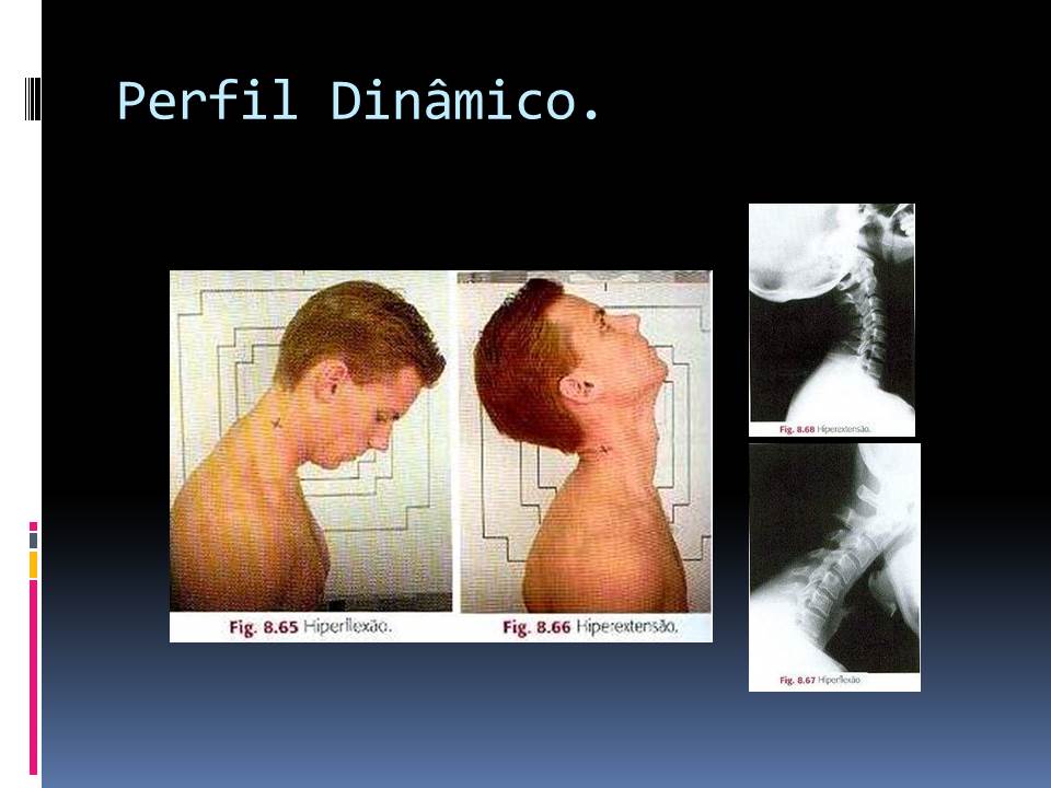 Radiologia Dinâmica: Cervical Dinâmico - Flexão e Extensão.