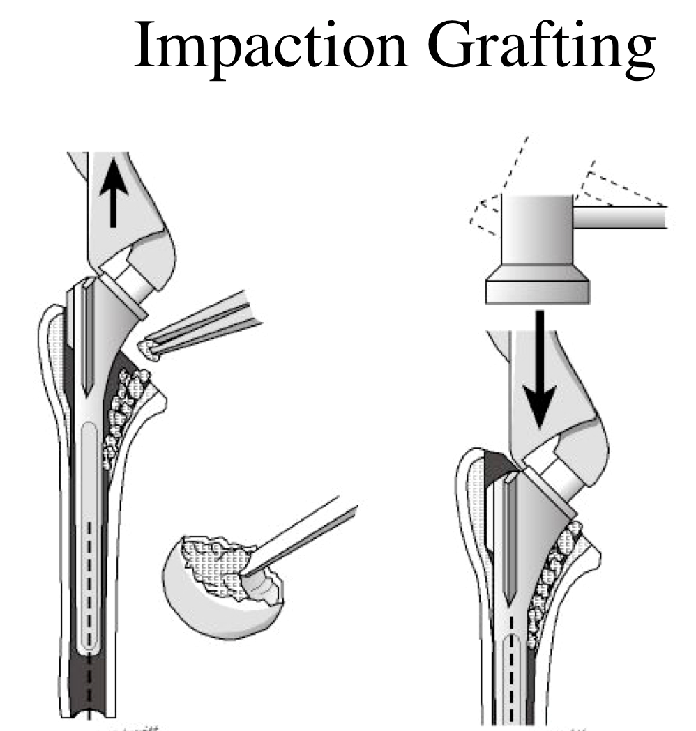UW Shoulder and Elbow Academy: The case for and art of impaction grafting