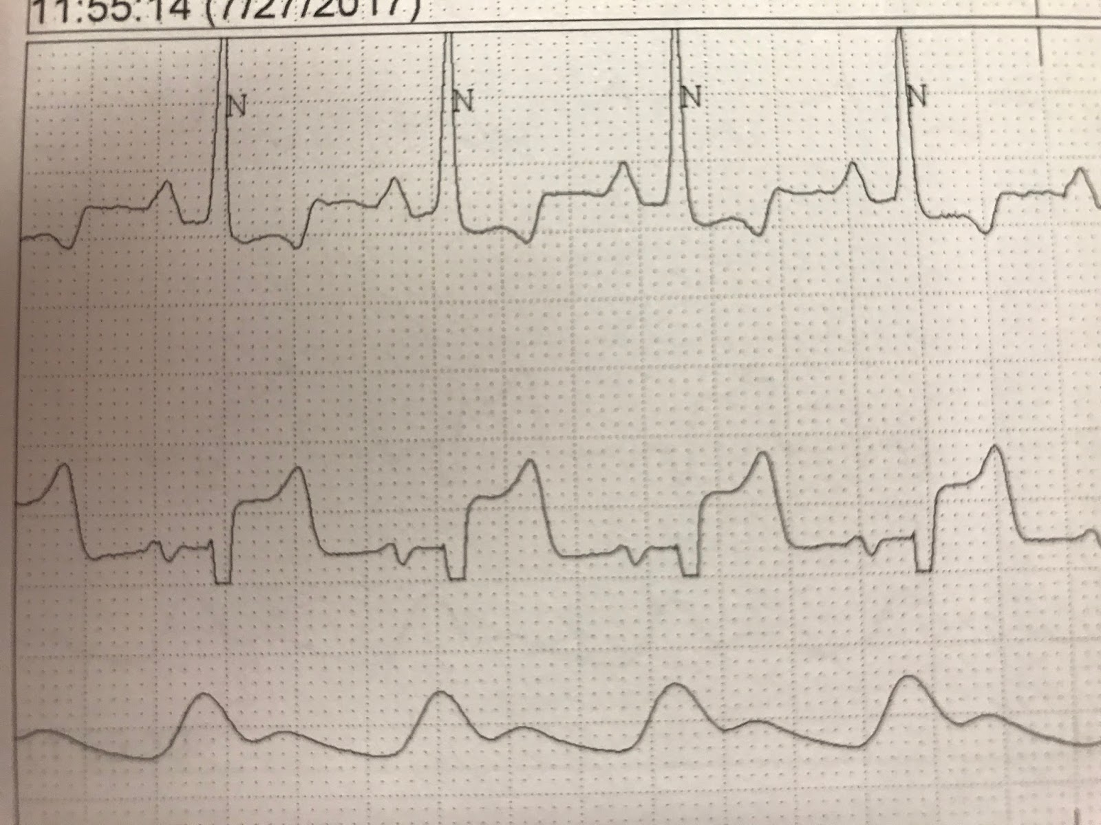Dr. Smith's ECG Blog: Chest Pain and ST Elevation on the Monitor