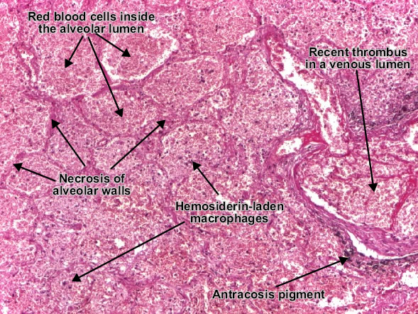 موقع الدكتور أحمد كلحى: صور باثولوجى - Pathology Slides : Pulmonary ...