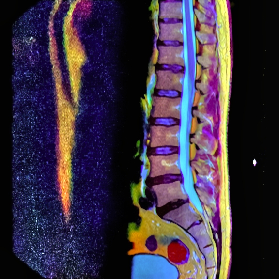 Nevit's blog: Color MRI of the Lumbar vertebrae