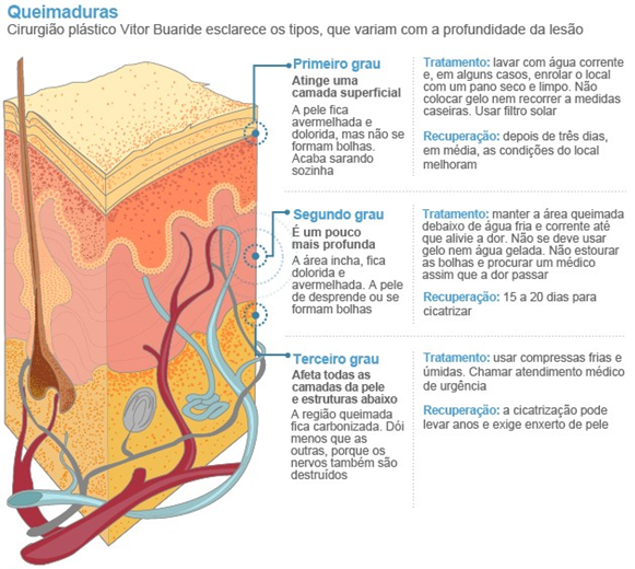 Medissante: Grande queimado - Queimaduras
