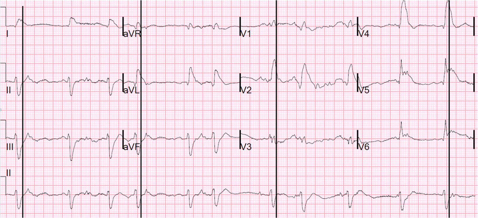 Dr. Smith's ECG Blog: ST Elevation in Lead aVR, with diffuse ST ...