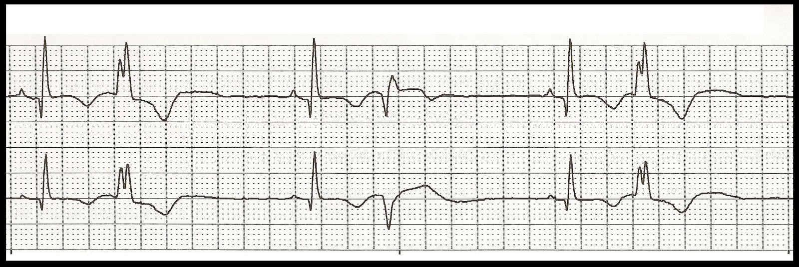 ECG Rhythm Strip Quiz 95 Ventricular ectopy