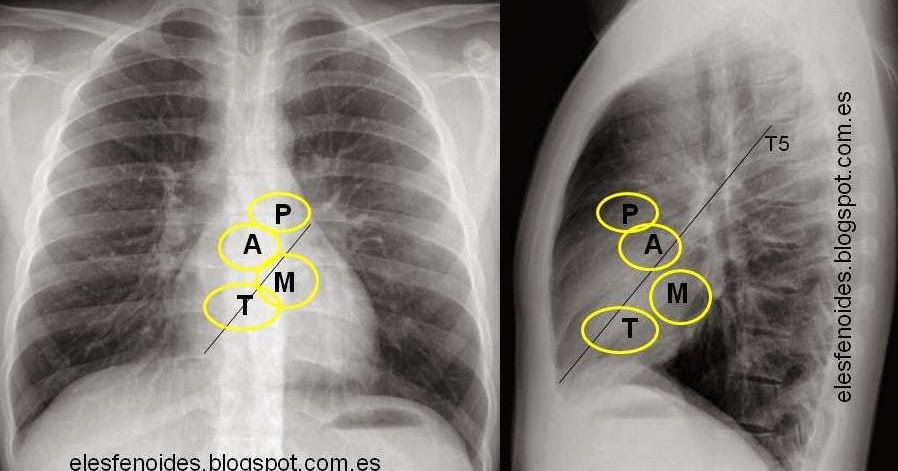 El esfenoides: Válvulas cardíacas en Rx de tórax.