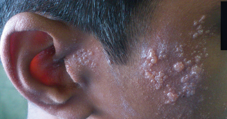 Herpes Zoster Oticus Herpes Zoster (Shingles) Infectious Dis.