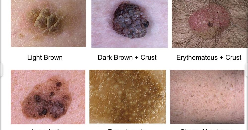 Agen Resmi Dan Terpercaya Obat Kutil Kelamin Paling Dipercaya Ampuh