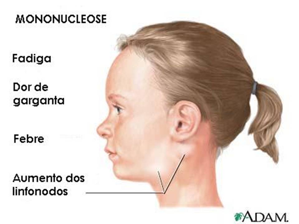 SOS Saúde: Mononucleose infecciosa