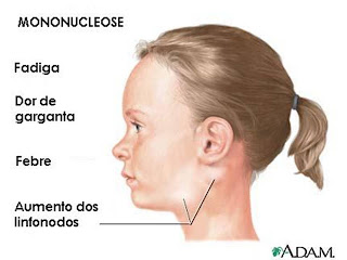 SOS Saúde: Mononucleose infecciosa