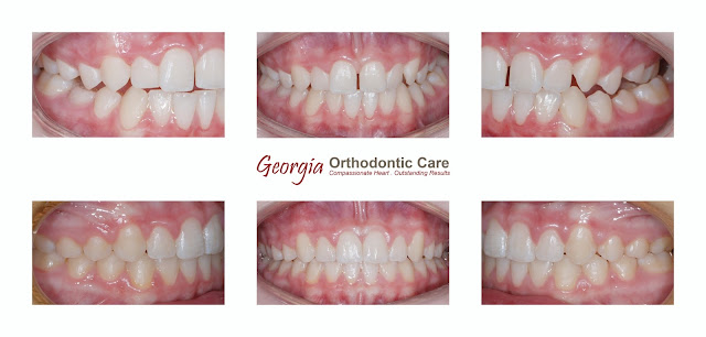 GEORGIA ORTHODONTIC CARE - LAWRENCEVILLE & NORCROSS GA: Unilateral ...