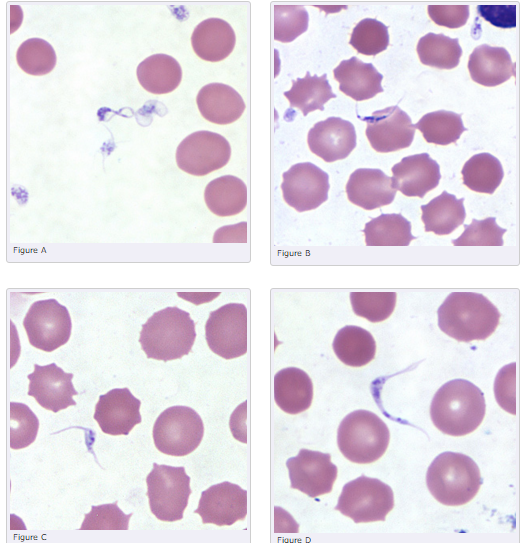 Casos clínicos e diagnósticos | HEMATOLOGADOS