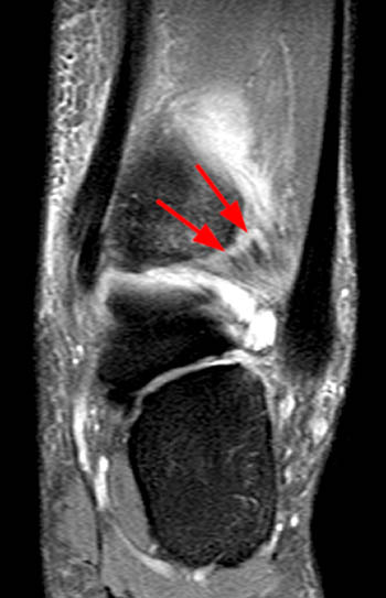 MRI Musculo-Skeletal Section: High ankle sprains.