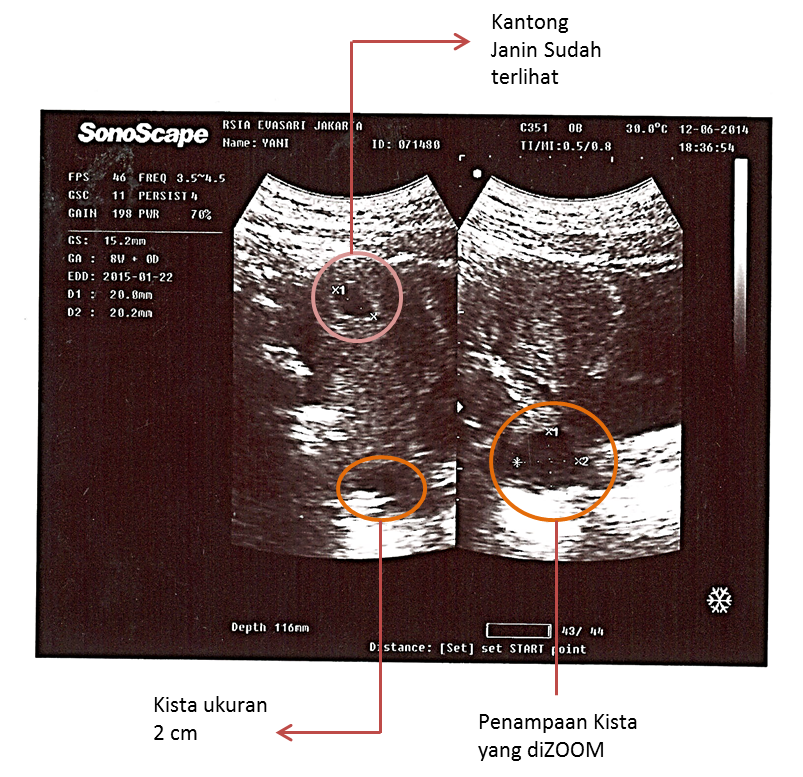 Kehamilan Pertamaku Minggu ke -6 | My Journal