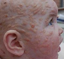 Mastocitose; Doença Mastocitária; Doença de Mastócitos