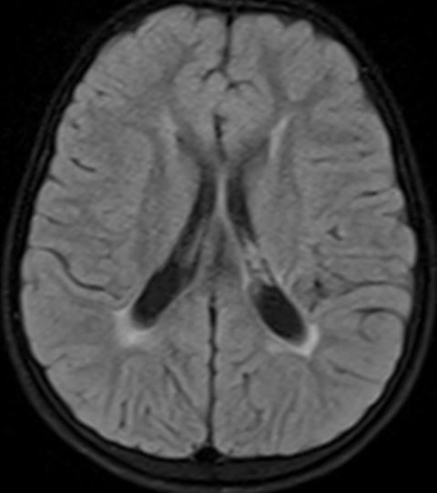 Leukomalacia, Periventricular; Encephalomalacia, Periventricular ...