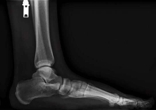 A Runner's Life: REDEFINED: What the heck is PTTD and why do I need ...