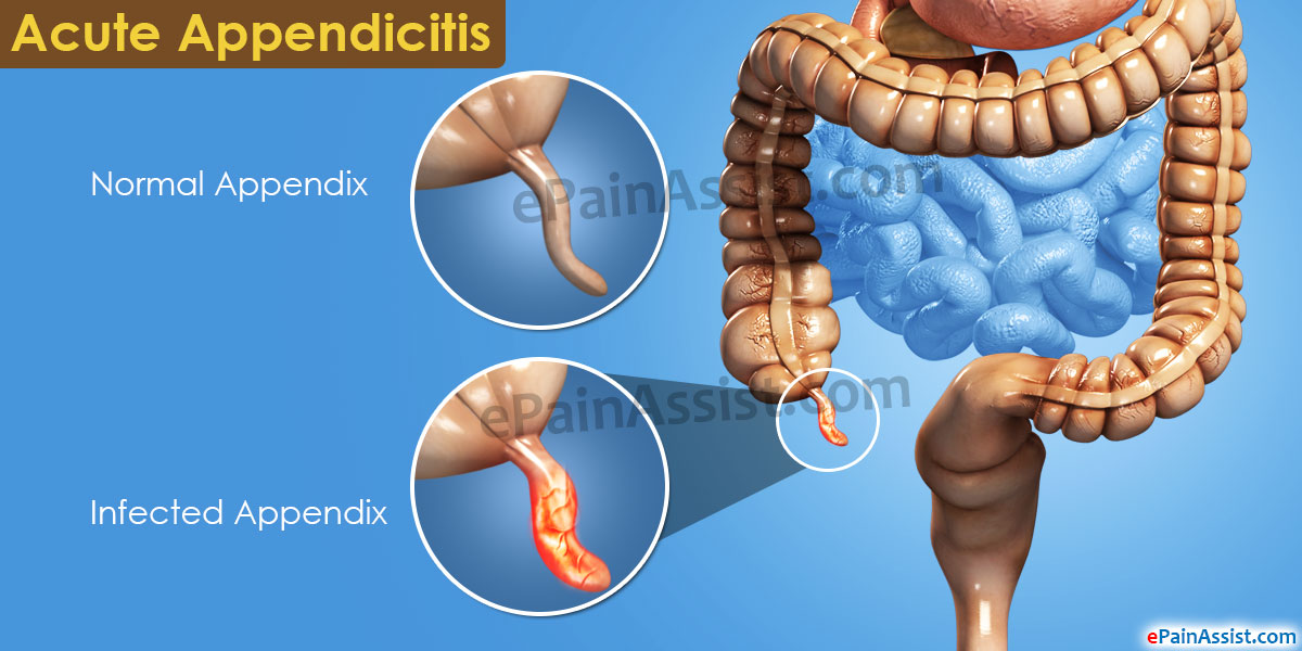 Acute Appendicitis With Appendicolith Image