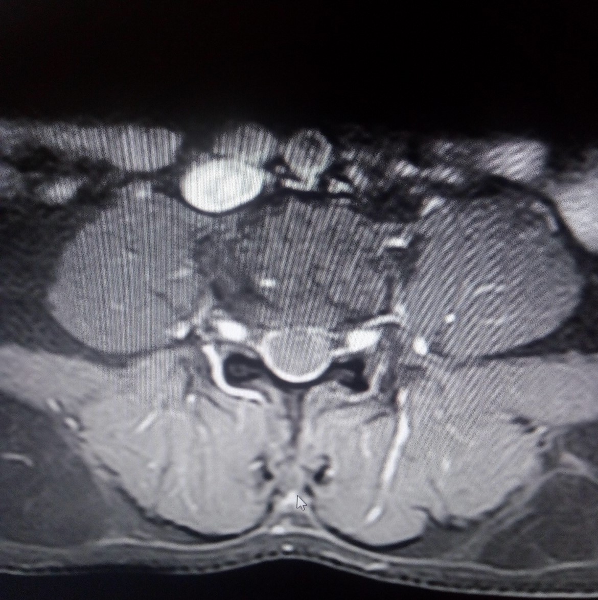 Cauda equina mass: An Approach - Sumer's Radiology Blog
