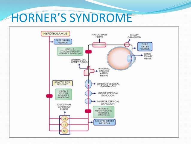 Physio knowledge BD: Horners syndrome