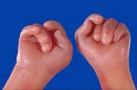 Medical Treatment Pictures-for Better Understanding: Edwards Syndrome