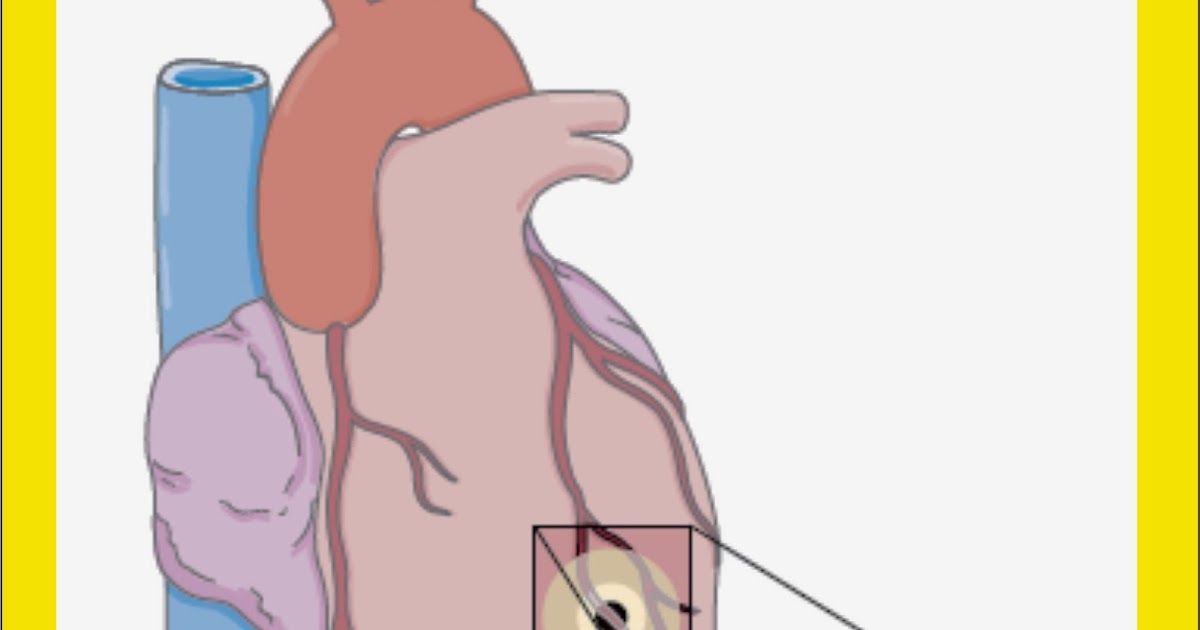 Miokard infark (Myocardial Infarction)