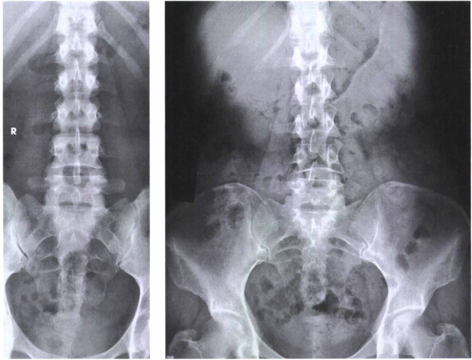 Gudang Medis: teknik radiografi LS (Lumbosakral)