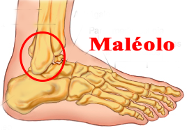 FRATURA DO TORNOZELO (MALÉOLO LATERAL): FRATURA DO TORNOZELO (MALÉOLO ...