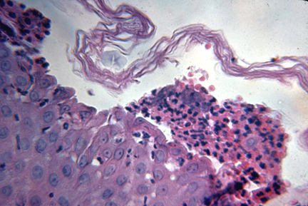 EL RINCÓN DE LA MEDICINA INTERNA: DERMATOSIS NEUTROFÍLICAS.