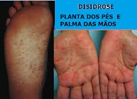 Pés e Mais Podologia: DISIDROSE