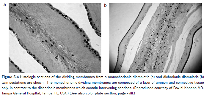 The Monochorionic Placenta | Twin-Twin Transfusion Syndrome (TTTS)