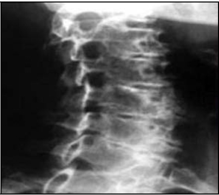 Detodounpoco: Artrosis cervical = Dolor