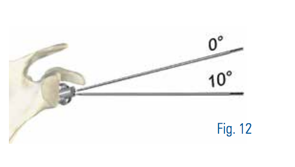 Shoulder and Elbow Surgery: The ideal position of the glenosphere in ...