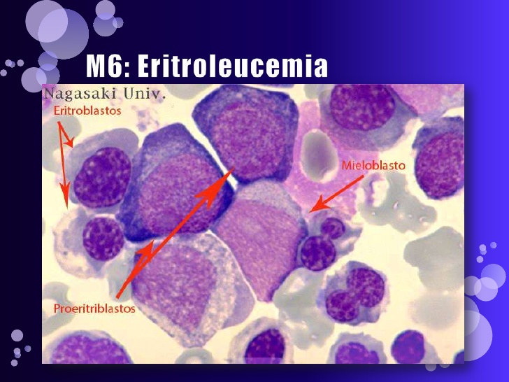 Células Sanguíneas: Leucemias Mieloides Agudas