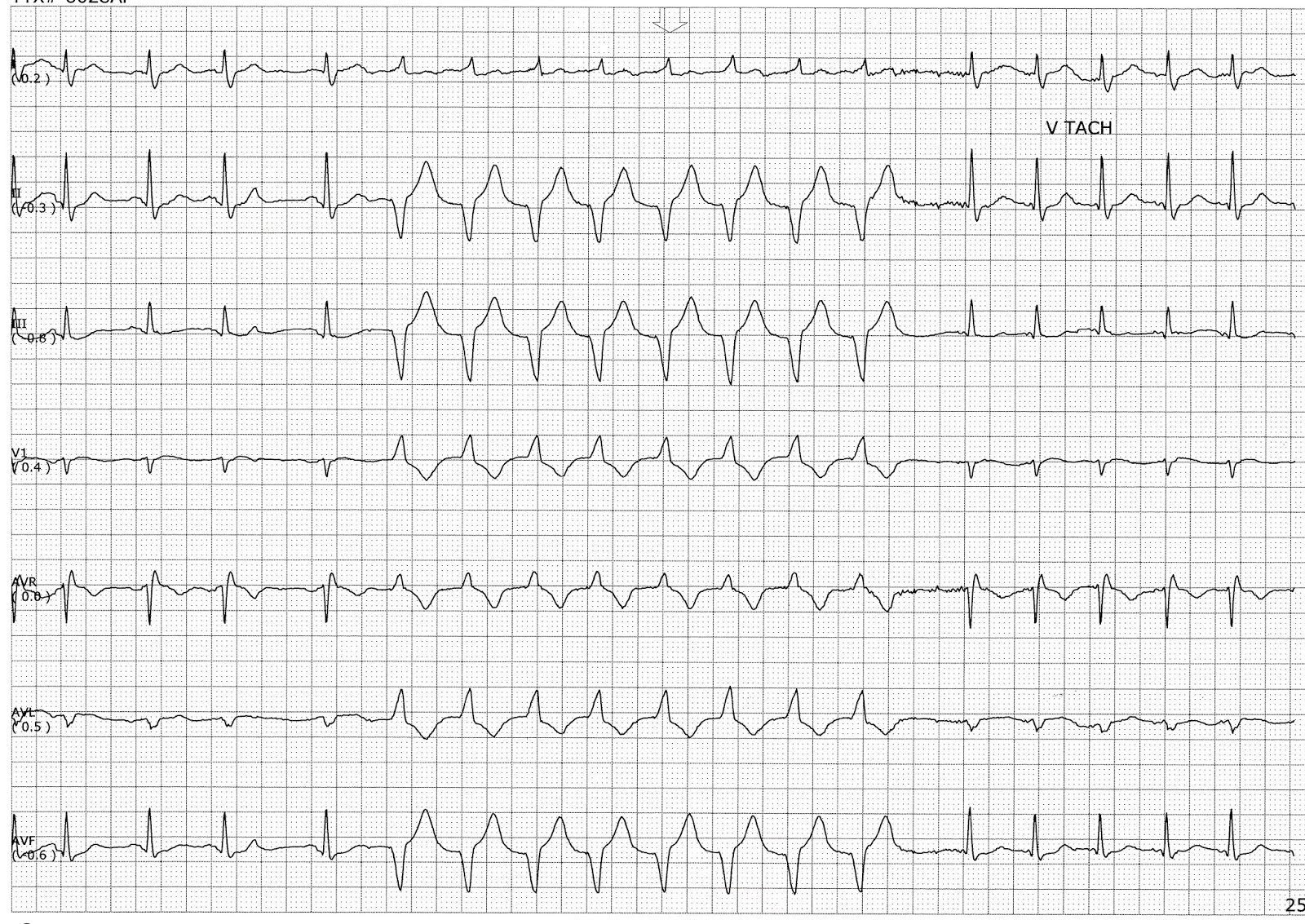Sinus rhythm with a run of non-sustained VT