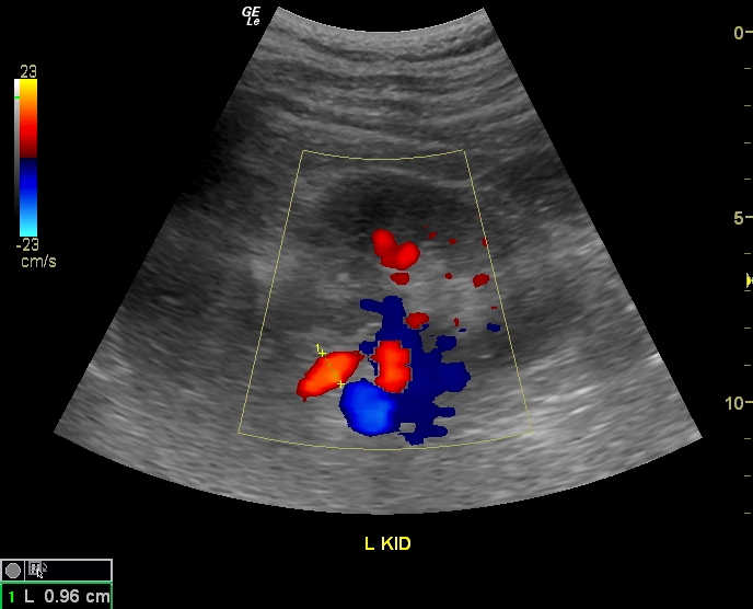 cochinblogs: Normal renal arterial color doppler study
