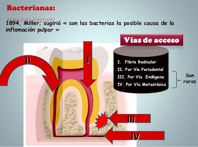 INFLAMACIÓN PULPAR: Diagnóstico y Tratamiento