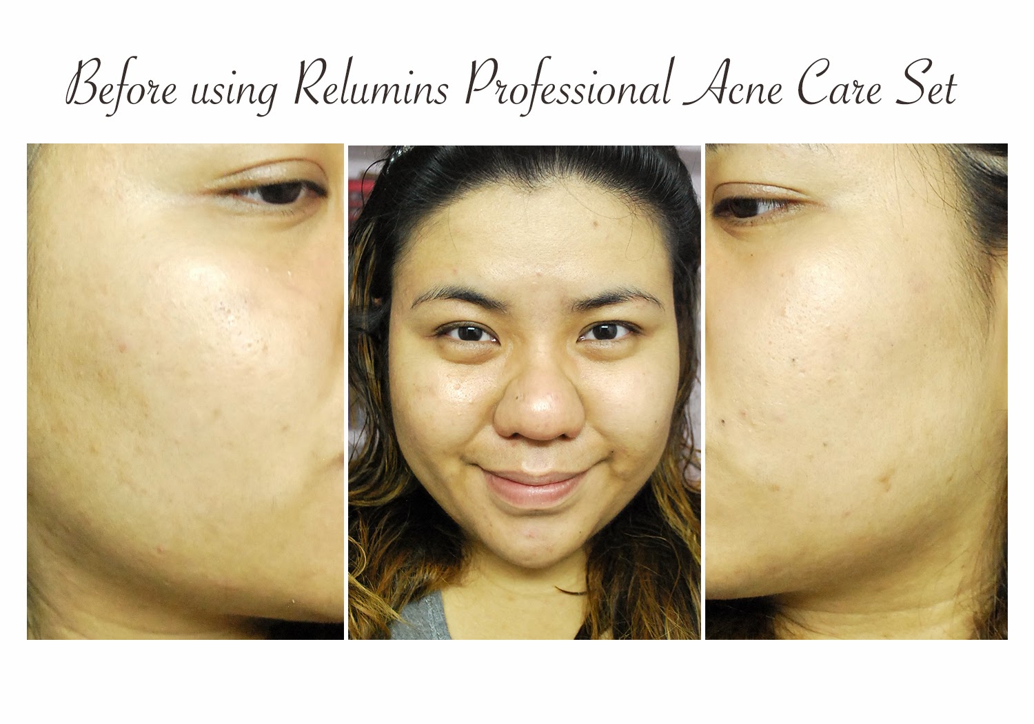 Peachy Pink Sisters: My One Month with Relumins Acne Clear Range (Review)