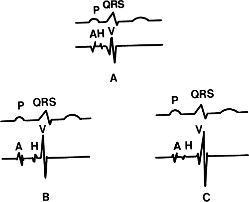 Dr Han Naung @ Henry Han : Electrophysiology and Heart Rhythm : Bundle ...