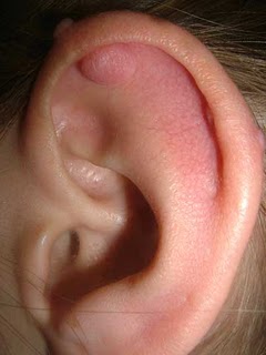 Hypertropic Scarring on Ear! : r/piercing