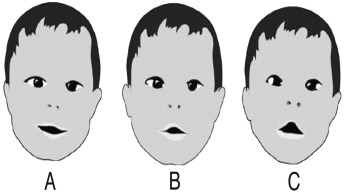 Neuro-Blogando: Síndrome de Moebius (Möbius) ou Diplegia Facial Congênita