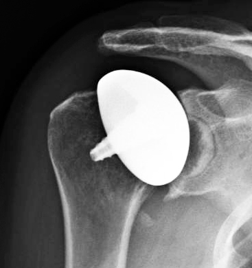 UW Shoulder and Elbow Academy: Why all these different approaches to ...