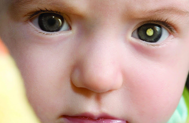 Retinoblastoma | Health articles for healthy living