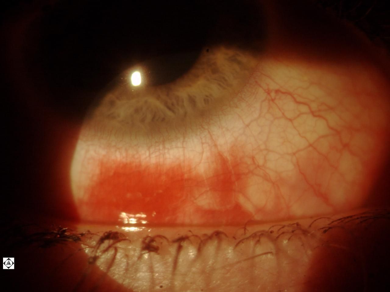 Sonoran Desert Eye Center: HEMORRHAGIC VIRAL CONJUNCTIVITIS