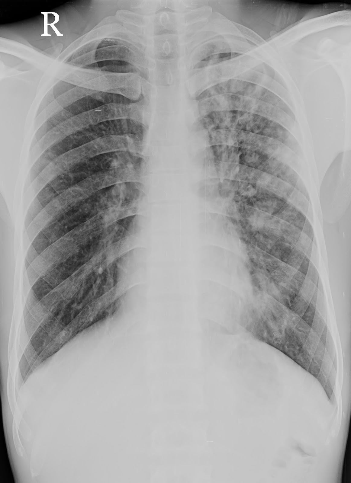 images for x ray: x-ray chest pa tuberculosis