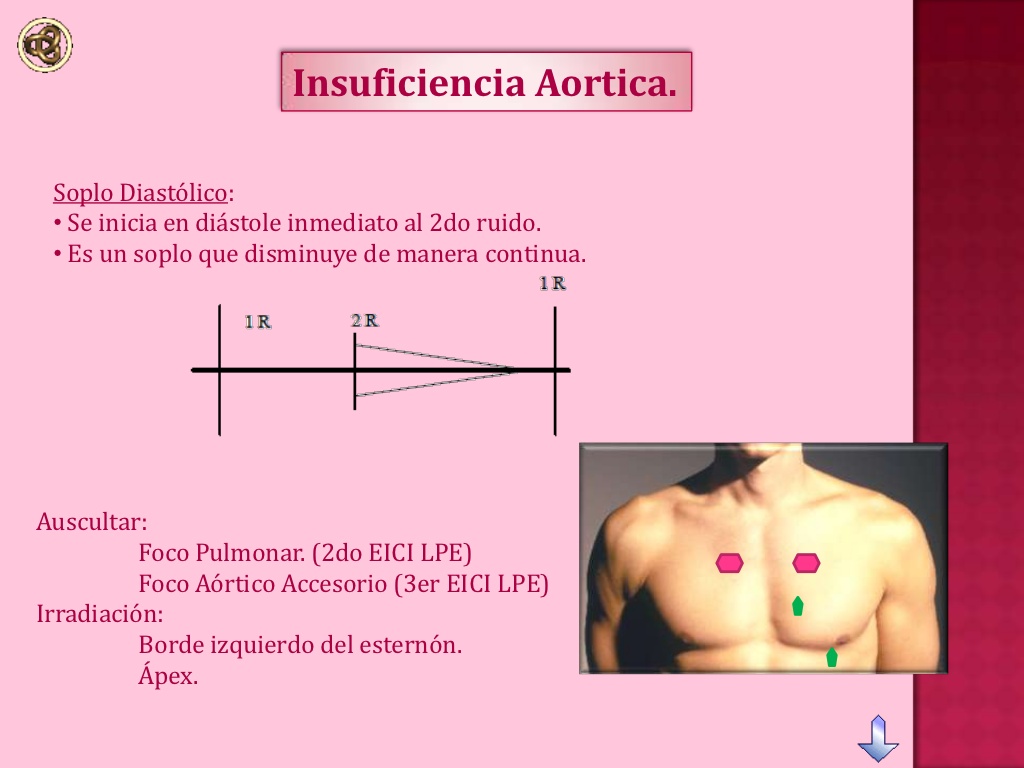 Soplos Cardiacos: Insuficiencia Aortica