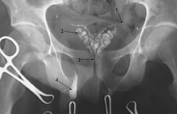 Kiến thức Y khoa nam học cho người Việt: [Giải phẫu] Ống dẫn tinh - Vas ...